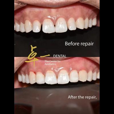 China Say Hello To A Flawless Smile With Cosmetic Dental Veneers No Discoloration No Preparation for sale