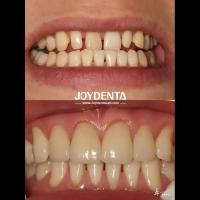 China Long-lasting Dental Veneers No Discoloration Perfect For B2B Sourcing Needs And More for sale