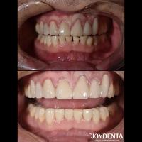 China Nature Shape Cosmetic Dentistry Porcelain Veneers , Dental Cosmetic Porcelain Veneers for sale