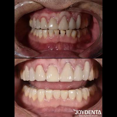 China Nature Shape Cosmetic Dentistry Porcelain Veneers , Dental Cosmetic Porcelain Veneers for sale