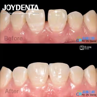China Secure Fit Porcelain Veneers Dental Treatment Composite Resin Veneers Stain Resistant for sale