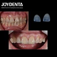 China 0.5mm Thickness Ceramic Dental Veneers Natural Looking For Anterior Tooth Indication for sale