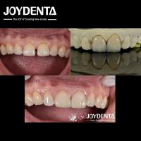China 0.5mm Thickness Dental Veneers Perfect Permeability Porcelain Veneers for sale