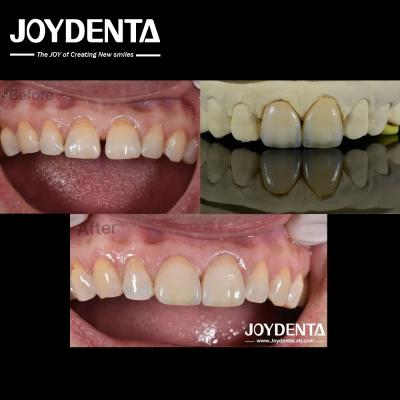 China 0.5mm Thickness Dental Veneers Perfect Permeability Porcelain Veneers for sale