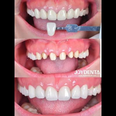 China Zirconia Dental Crown Case Study | Global Lab Outsourcing - Joydentalab for sale