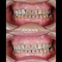 China Lightweight Dental Zirconia For Optimal Patient Experience Natural Color for sale