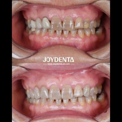 China Lightweight Dental Zirconia For Optimal Patient Experience Natural Color for sale