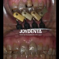 China Translucency Zirconia Crowns Multilayered Gradient Technology for sale