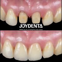 China High Fracture Resistance Dental Zirconia And Multilayered Gradient Technology for sale