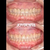 China Dental Zirconia For Safe Oral Tissue And CAD / CAM Compatibility for sale