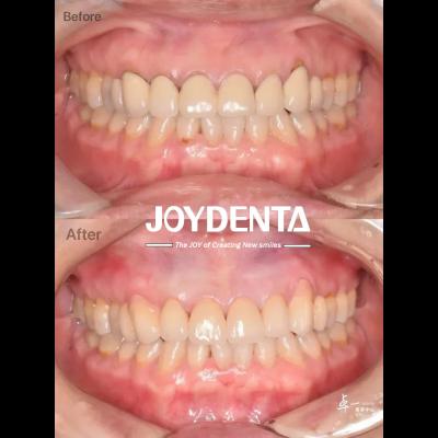 China Dental Zirconia For Safe Oral Tissue And CAD / CAM Compatibility for sale