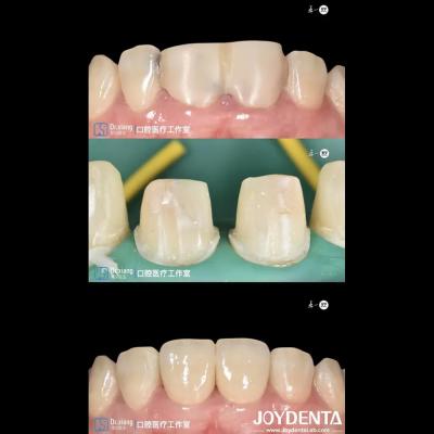 China Perfectly Fit teeth Zirconia Dental Crowns With CAD CAM Systems for sale