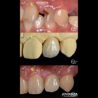 China Lifelike Tooth Appearance Zirconia Bridges Dental Restoration Wear Resistant for sale