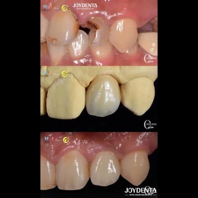 China Lifelike Tooth Appearance Zirconia Bridges Dental Restoration Wear Resistant for sale