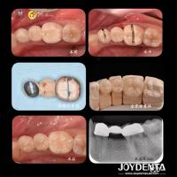 China Tailored Dental Zirconia Crown Biocompatibility Comfort Customization for sale