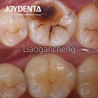 China Porcelain Dental Inlay Restorative For Adults And Children Exceptional Performance for sale