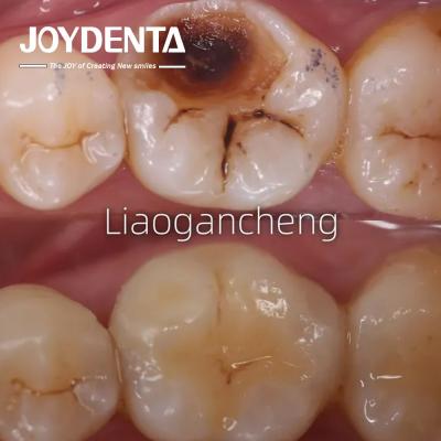 China Porcelain Dental Inlay Restorative For Adults And Children Exceptional Performance for sale