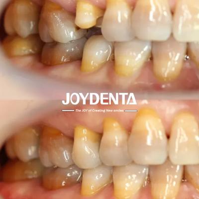 China Customizable Affordable Dental Inlay Restorative Precise Fit For Damaged Teeth for sale