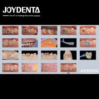 China Adults Children Porcelain Ceramic Dental Inlay Restorative for Damaged Teeth for sale