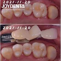 China Seamless Fit Porcelain Inlay Dental Procedure Customizable Shape For Teeth Repair for sale