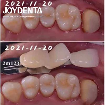 China Seamless Fit Porcelain Inlay Dental Procedure Customizable Shape For Teeth Repair for sale