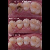China Accurate Fit Dental Porcelain Inlay Damaged Teeth Restoration for sale