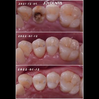 China Accurate Fit Dental Porcelain Inlay Damaged Teeth Restoration for sale