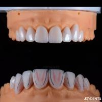 China Custom Made Dental Emax Ceramic Veneers With Stain Resistance High Gloss for sale