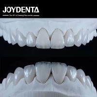 China Natural Looking Emax Porcelain Veneer Comfortable Fit Ultra Thin Emax Veneers for sale