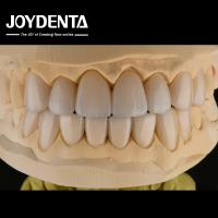 China 0.3-0.5mm Thick Feldspathic Porcelain Veneer High Fracture Resistance Upgrade Your Smile for sale