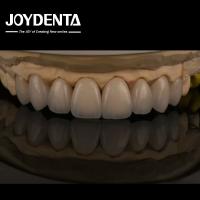 China Feldspathic Natural Looking Cosmetic Veneers Precise Fit Highly Translucent for sale