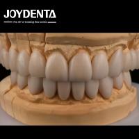 China 0.3mm Thickness Ips Emax Veneers Ceramic Veneers Anterior Posterior Restorations for sale