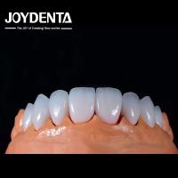 China A1-A4 Ips Emax Press Porcelain Dental Veneers Stain Resistant Customizable Shape for sale
