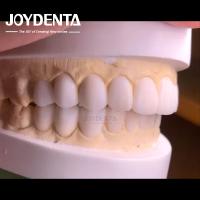 China Customized Digital Diagnostic Wax Ups for Natural Tooth Anatomy Replication for sale
