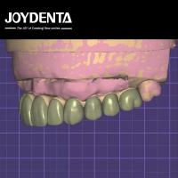 China HIPAA Compliant Data Security Digital Wax Up 3D Model For Dental Modifications for sale