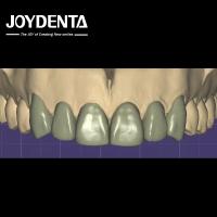 China 3D Printing Virtual Digital Wax Up Seamless Compatibility With Other Dental Software for sale