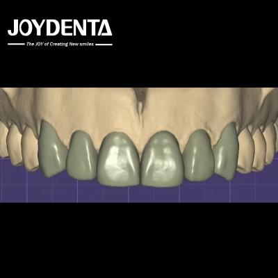 China 3D Printing Virtual Digital Wax Up Seamless Compatibility With Other Dental Software for sale