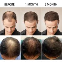 China Customization Hair Growth Treatment Serum for Black Women Private Label for sale