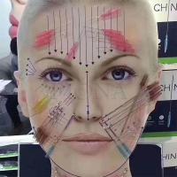 China 27G 50mm PLLA Thread Lift , Thread Eyebrow Lift for sale