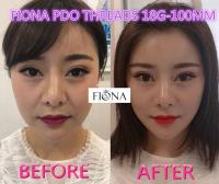 China Fiona PDO And PCL Thread , 38mm Face Lift PDO Thread for sale