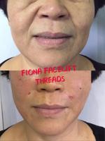 China Absorbable  PDO & PCL 19G Mesh Thread for  Deep Wrinkles filling for sale