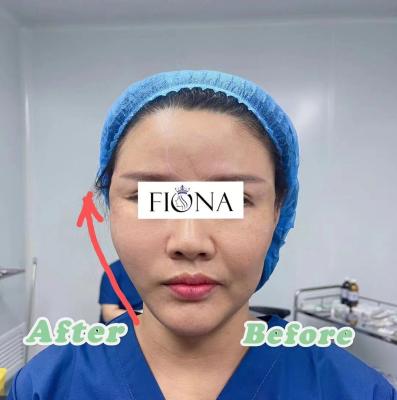 China Absorbable PDO Cog Thread Lift EO Gas Sterilized For Eyebrow Lift Fox Eyes for sale