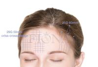 China PLACL PCL PDO Cog Threads / Barbed Threads For Foxy Eye Ponytail Lifting 360 4D 6D 12D for sale