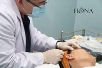 China Non-surgical face lifting PDO PCL PLACL Cog Thread Face Lift 360 4D 6D 12D W Cannula for sale