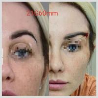 China PLACL PCL PDO Cog Threads / Barbed Threads For Foxy Eye Ponytail Lifting 360 4D 6D 12D for sale