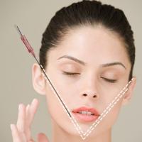 China Nonsurgical PDO Thread Face Lifting Cog Thread 18G 100mm For Instant Face Lifting for sale