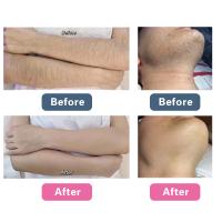 China Portable Diode Laser Hair Removal Machine 808 755nm 1064nm Triple Wavelength for sale