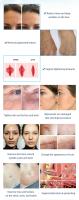 China Medical Fractional CO2 Laser Machine Stationary Style for Scar Removal for sale
