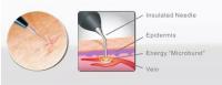 China Beauty Salon 980nm Diode Laser Machine  For  Relief / Vascular Treatment for sale