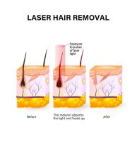 China Commercial Home Portable Permanent Laser Hair Removal Machine 808nm With Adjustable Head for sale